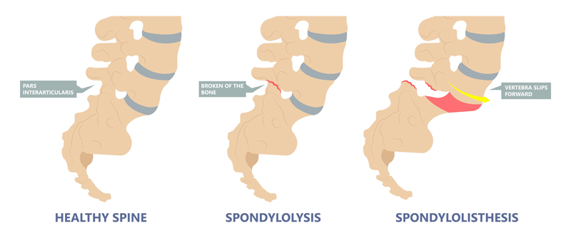 Spondylolisthesis - South Florida Orthopaedics & Sports Medicine